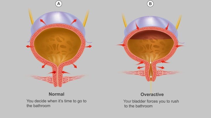 8 Ways to Tame Bladder Control Problems